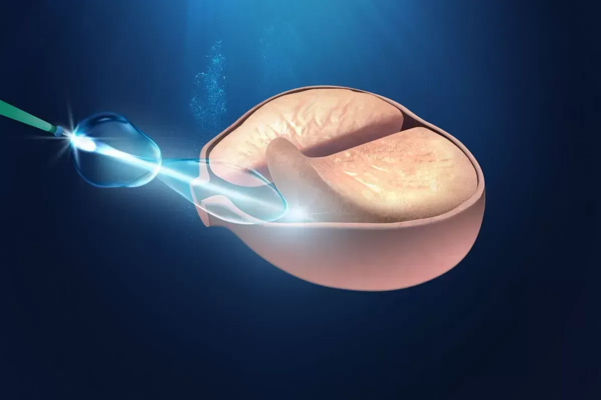 HoLEP: uma técnica inovadora no tratamento da hiperplasia prostática ...